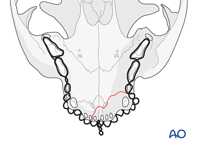Rostral intraoral splint fixation for Midface - Rostral fracture