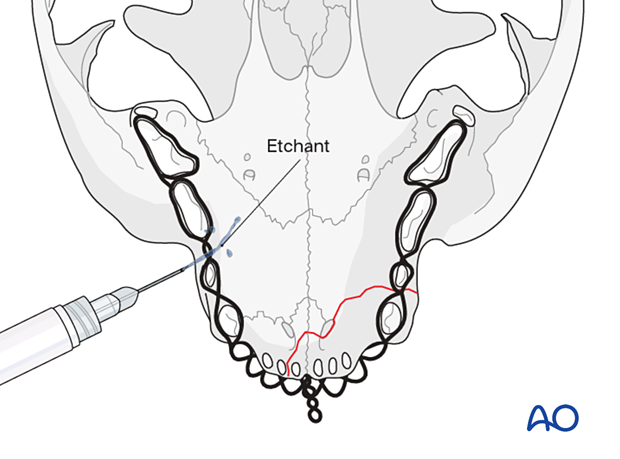 Rostral intraoral splint fixation for Midface - Rostral fracture