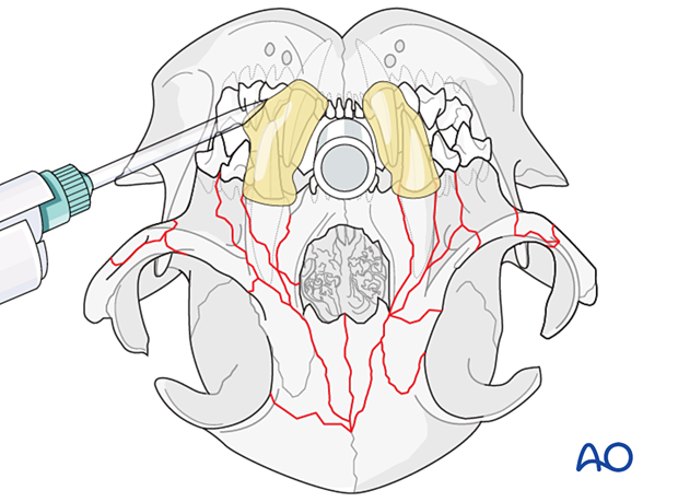 Maxillomandibular fixation (MMF) for Midface - Panfacial fracture