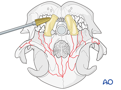 Maxillomandibular fixation (MMF) for Midface - Panfacial fracture