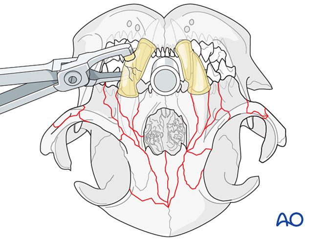 Maxillomandibular fixation (MMF) for Midface - Panfacial fracture