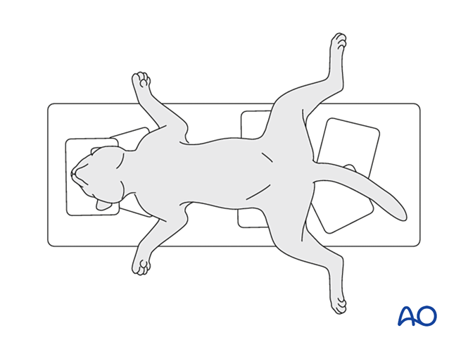 Circummandibular wiring for Mandible - Symphyseal separation