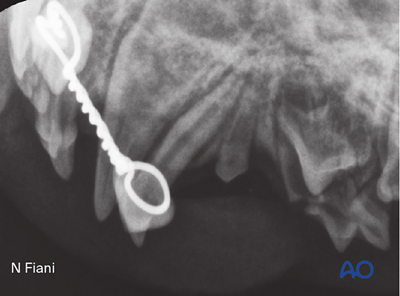 Management of fractures in the pediatric patient