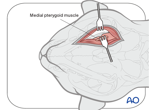 Ventral approach to mandibular body