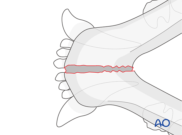 Mandible - Symphyseal separation