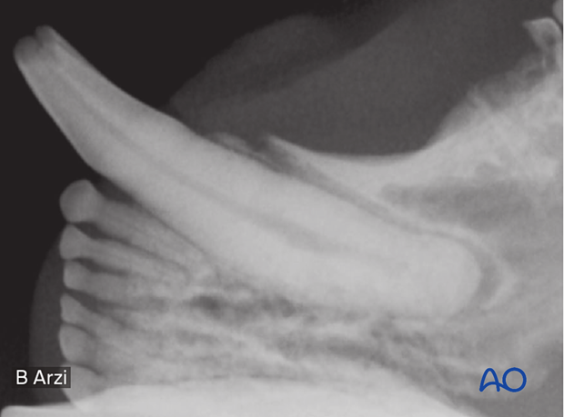 Mandible - Fractures of the ramus