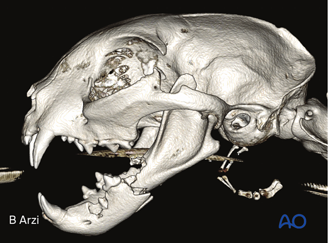 Mandible - Parasymphyseal fracture