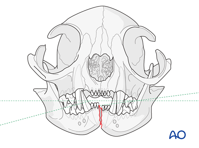 Mandible - Symphyseal separation