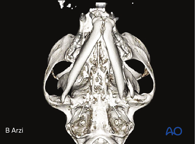 Mandible - Symphyseal separation