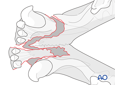 Mandible - Parasymphyseal fracture