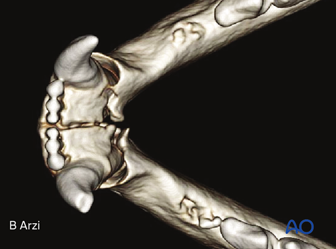 Mandible - Rostral fracture