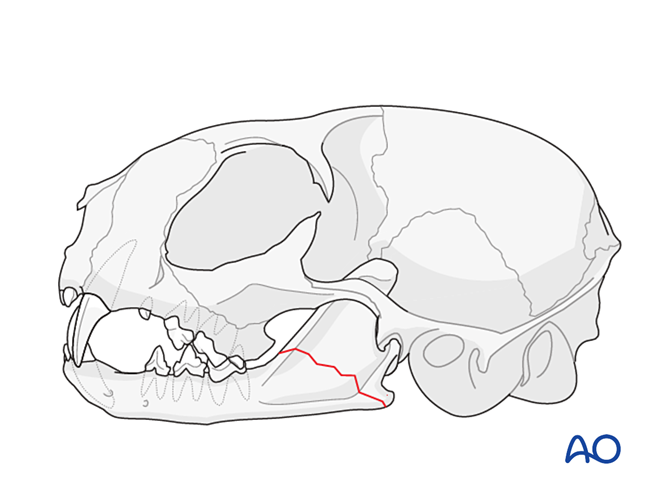 Mandible - Fractures of the ramus