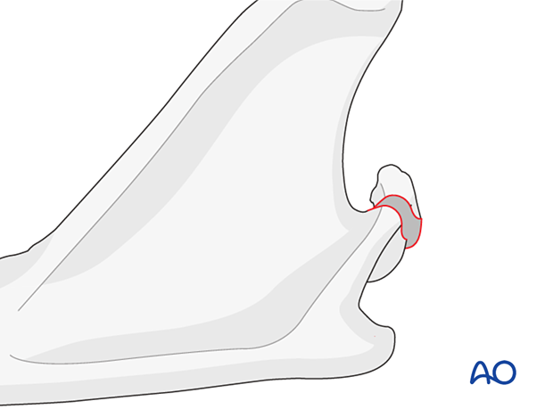 Mandible - Temporomandibular joint fracture