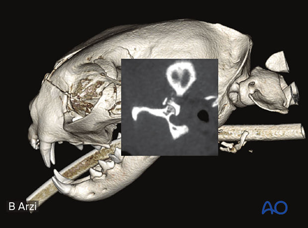 Mandible - Temporomandibular joint fracture