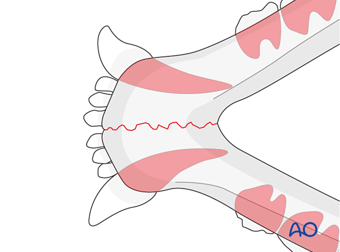 Circummandibular wiring for Mandible - Symphyseal separation