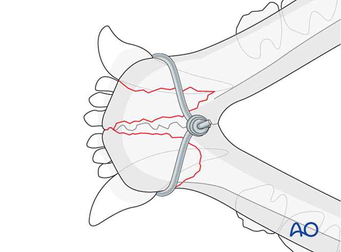 Circummandibular wiring and dental composite for Mandible ...
