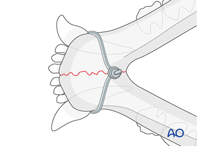 Circummandibular wiring for Mandible - Symphyseal separation
