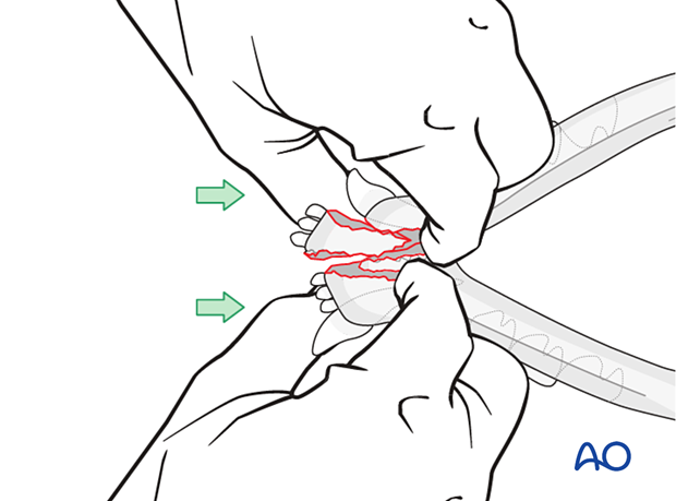 Circummandibular wiring and dental composite for Mandible ...