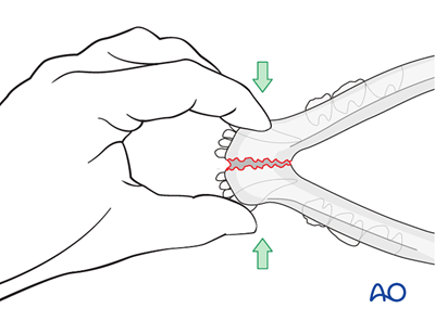 Circummandibular wiring for Mandible - Symphyseal separation