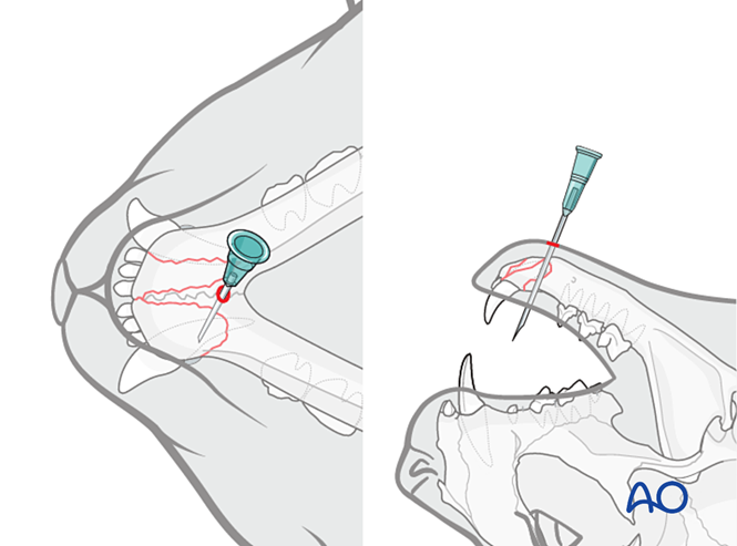 Circummandibular wiring and dental composite for Mandible ...