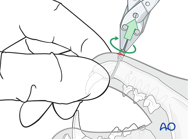 Circummandibular wiring for Mandible - Symphyseal separation