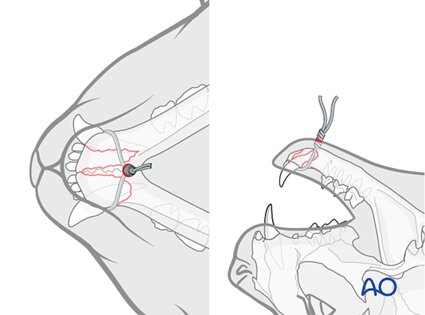 Circummandibular wiring and dental composite for Mandible ...