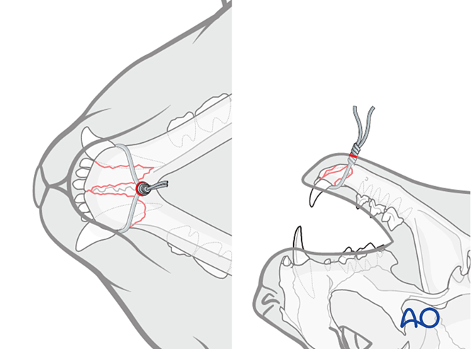 Circummandibular Wiring And Dental Composite For Mandible