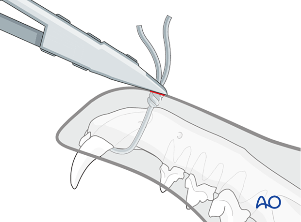 Circummandibular wiring for Mandible - Symphyseal separation
