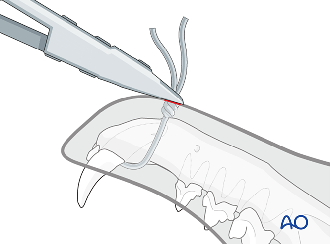 Circummandibular wiring for Mandible - Symphyseal separation