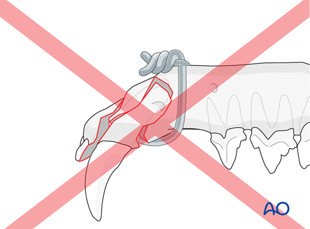 Circummandibular Wiring And Dental Composite For Mandible