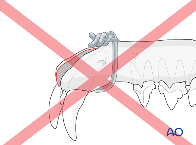 Circummandibular wiring for Mandible - Symphyseal separation