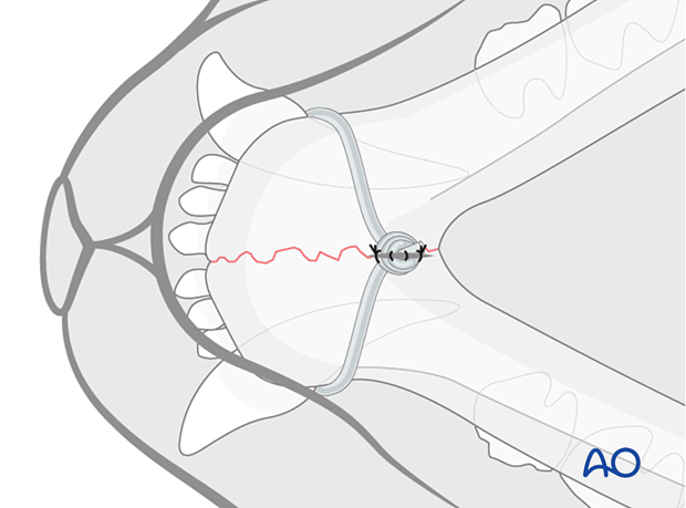 Circummandibular wiring for Mandible - Symphyseal separation