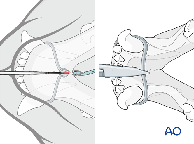 Circummandibular wiring and dental composite for Mandible ...