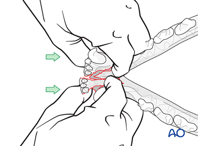 Wire reinforced intraoral splinting for Mandible - Parasymphyseal fracture