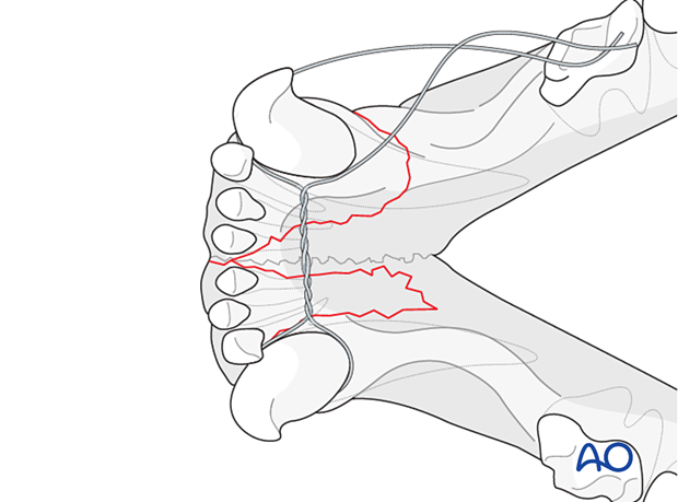 Wire reinforced intraoral splinting for Mandible - Parasymphyseal fracture