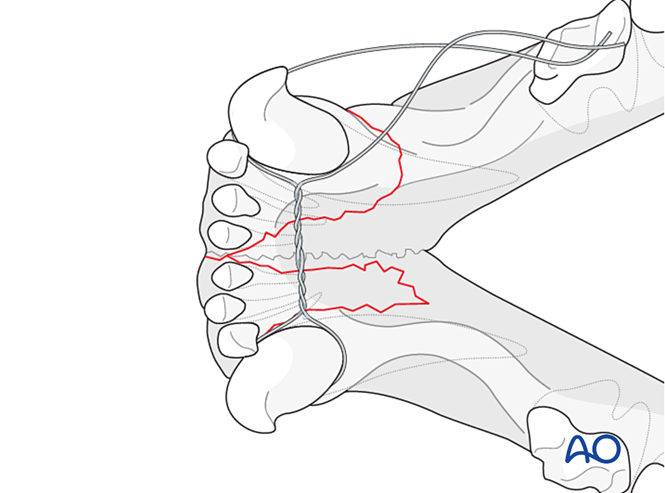 Wire reinforced intraoral splinting for Mandible - Parasymphyseal fracture