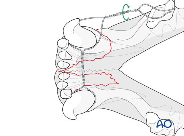 Wire reinforced intraoral splinting for Mandible - Parasymphyseal fracture
