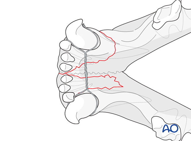 Wire reinforced intraoral splinting for Mandible - Parasymphyseal fracture