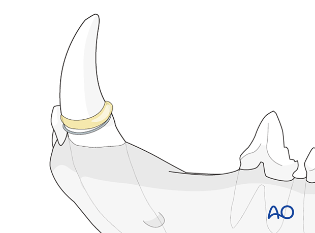 Wire reinforced intraoral splinting for Mandible - Parasymphyseal fracture