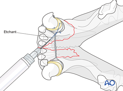Wire reinforced intraoral splinting for Mandible - Parasymphyseal fracture