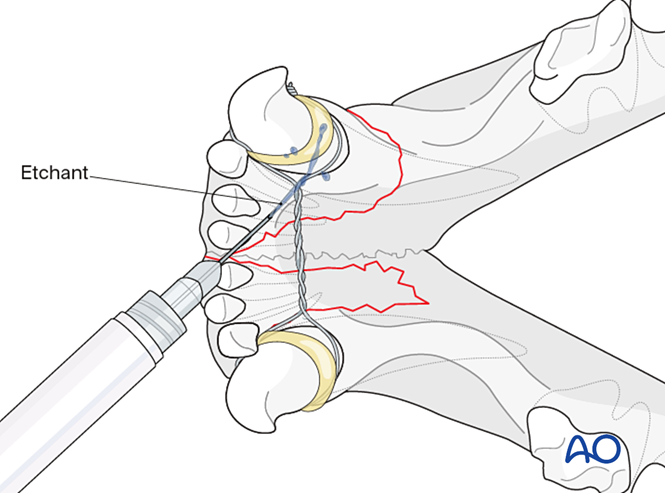 Wire reinforced intraoral splinting for Mandible - Parasymphyseal fracture