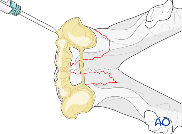 Wire reinforced intraoral splinting for Mandible - Parasymphyseal fracture