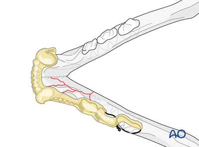 Wire reinforced intraoral splinting for Mandible - Rostral fracture
