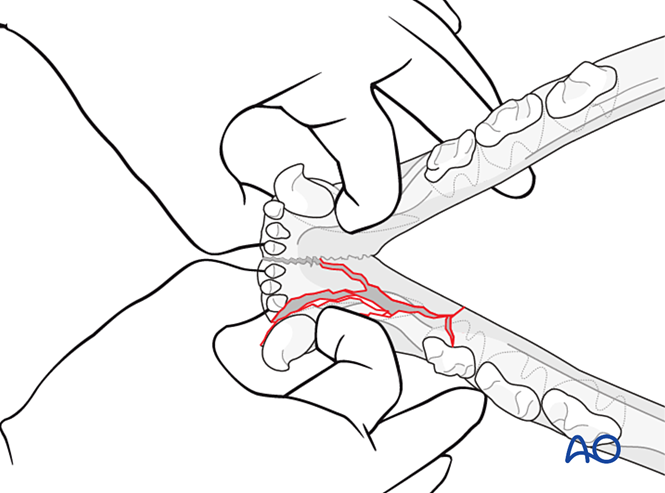 Wire reinforced intraoral splinting for Mandible - Rostral fracture