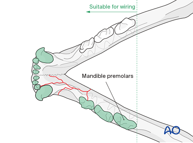 Wire reinforced intraoral splinting for Mandible - Rostral fracture