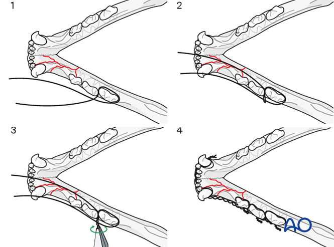 Wire reinforced intraoral splinting for Mandible - Rostral fracture