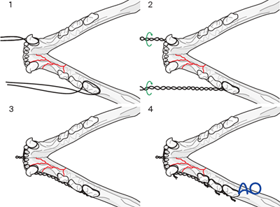 Wire reinforced intraoral splinting for Mandible - Rostral fracture