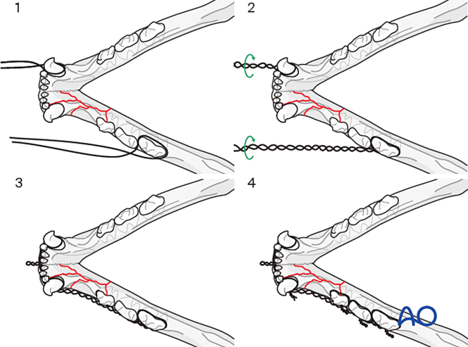 Wire reinforced intraoral splinting for Mandible - Rostral fracture
