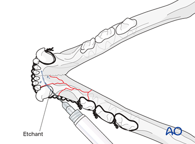 Wire reinforced intraoral splinting for Mandible - Rostral fracture