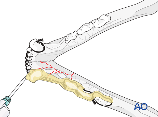 Wire reinforced intraoral splinting for Mandible - Rostral fracture